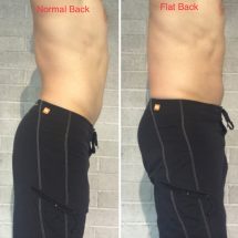 FLAT BACK HOW TO CORRECT ? | TREATMENT, EXERCİSE